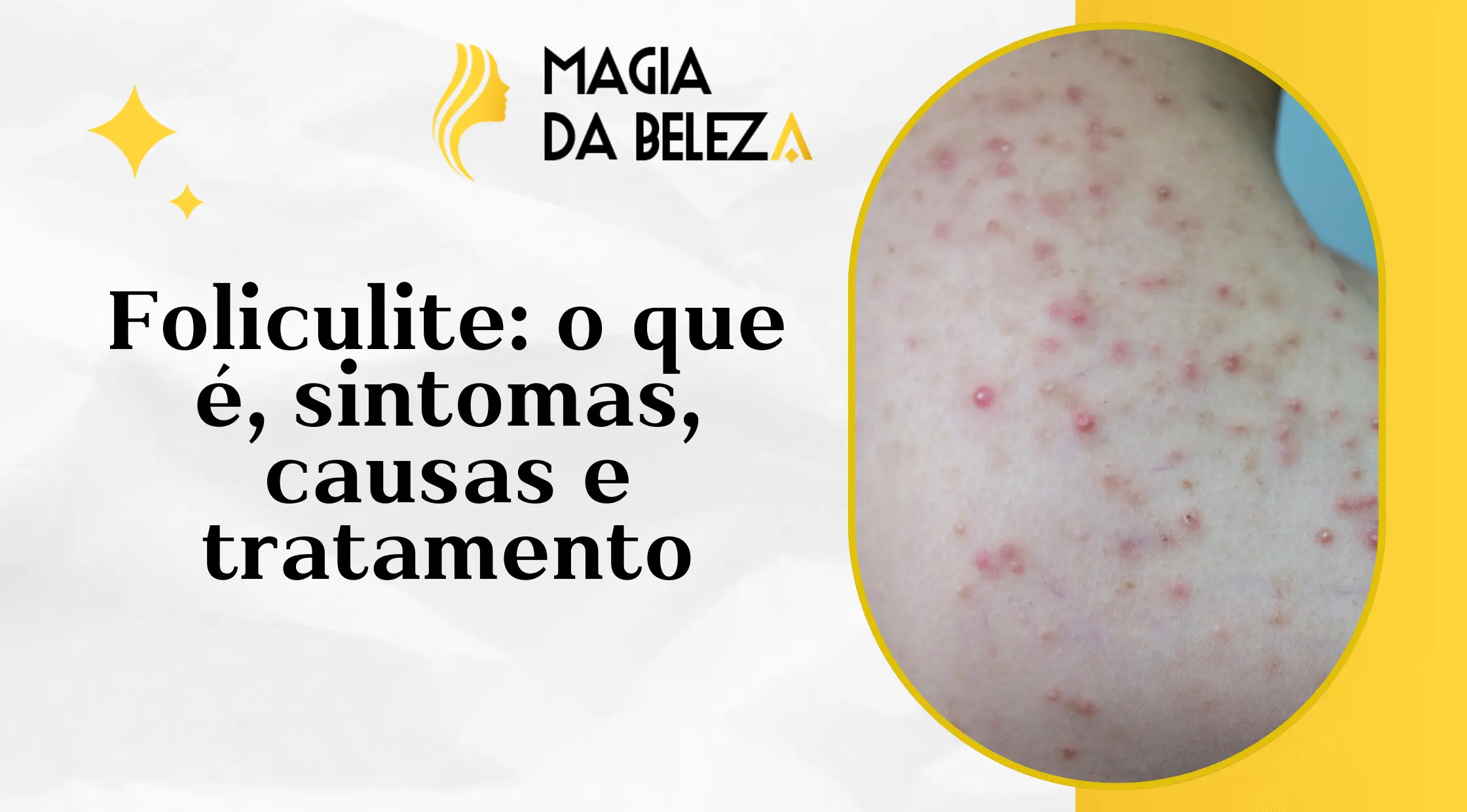 Foliculite: O Que É, Causas, Sintomas e Tratamento