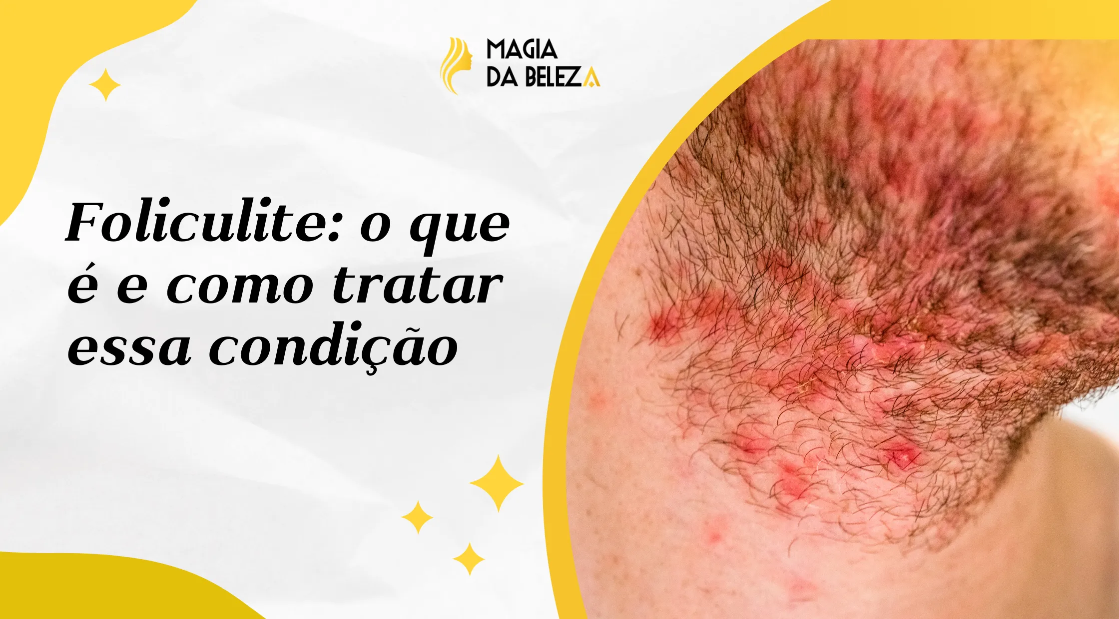 Foliculite: o que é e como tratar essa condição